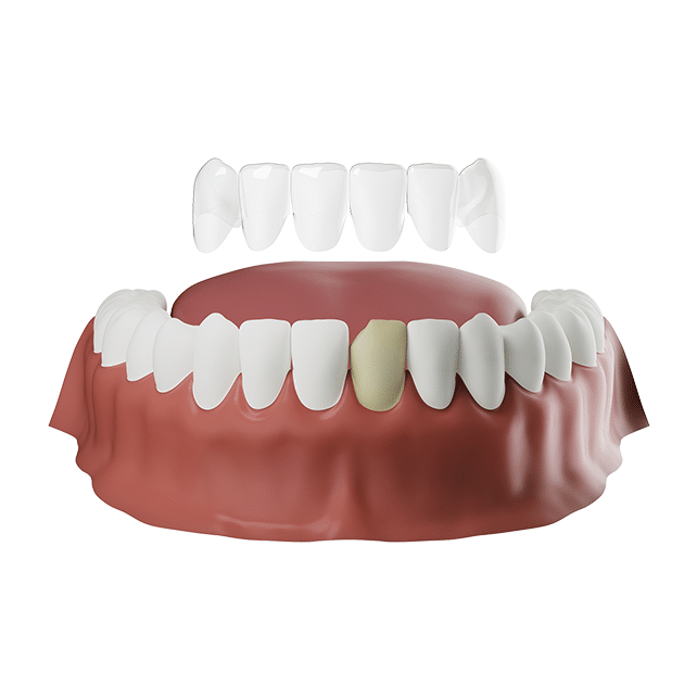 Snap-On Smile | Corpus Christi | Tide Dental & Orthodontics