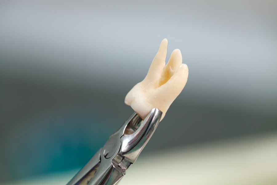 Wisdom Teeth Extraction: Local vs General Anesthesia